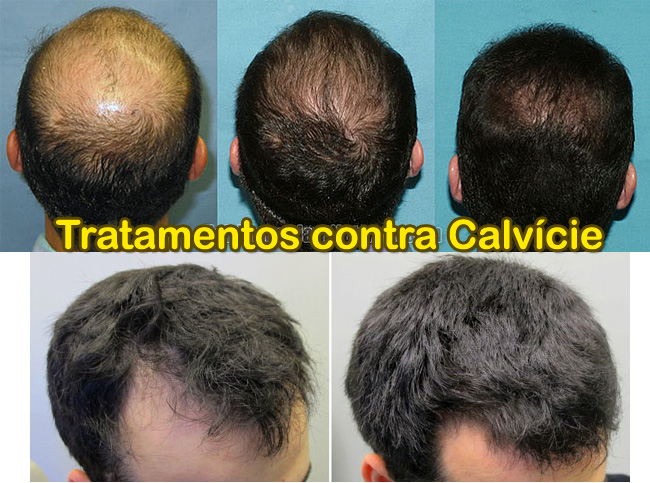 tratamento para calvice masculina e feminina ~ corte de cabelo da moda