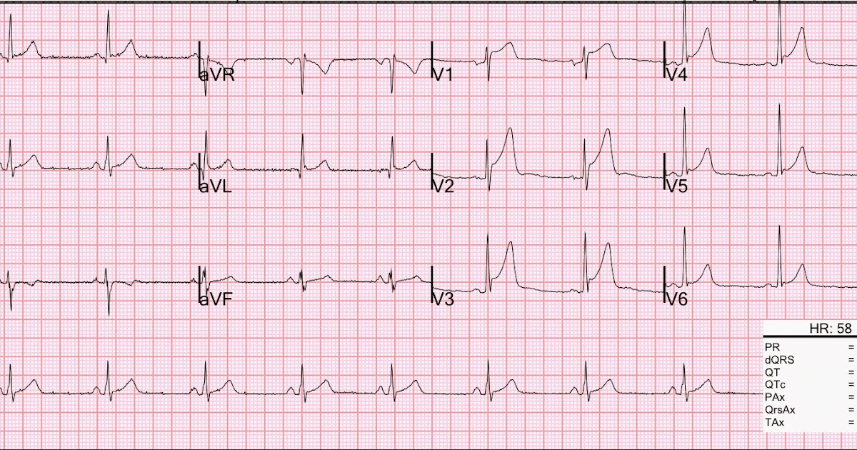 Dr. Smith's ECG Blog: Early Repolarization vs LAD Occlusion