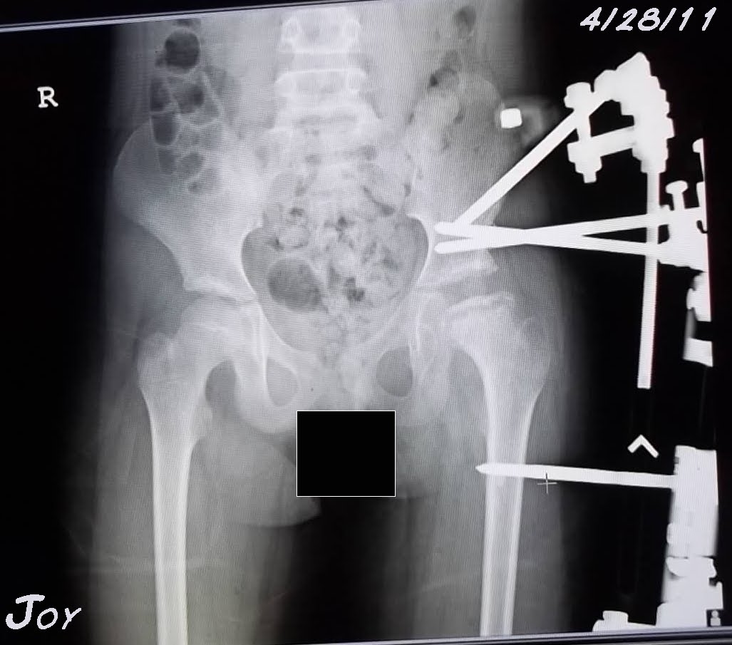 Perthes Princess (Joy's LCPD/AVN Journey): Ex-Fix X-Ray!