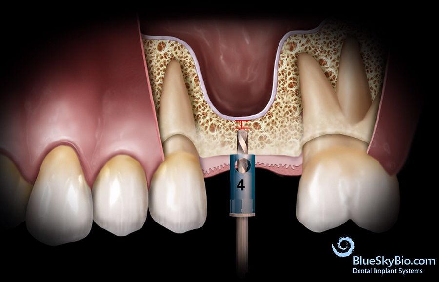 SINUS LIFT: Basic Hammerless Instrument Technique