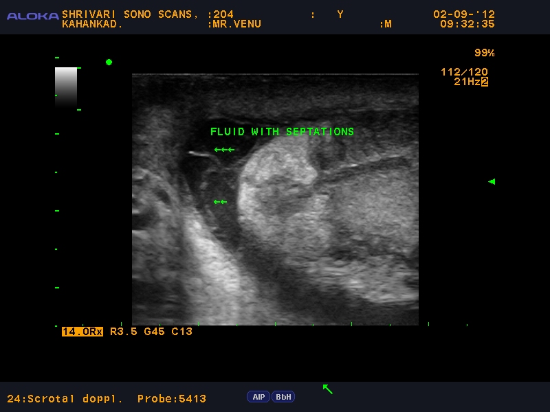 Shrivari Sono Scans: Hrsg imaging scrotum-Images of epididymis in Acute ...