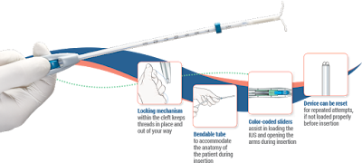 Ob/Gyn Updated : New Single Handed IUD Inserter for LILETTA released ...