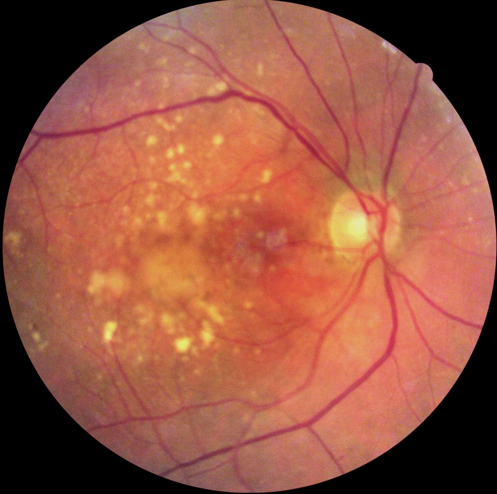 More Medicare Musings Why Lucentis Is Worth The Price Tag Eyedolatry More Medicare Musings Why Lucentis Is Worth The Price Tag Eyedolatry