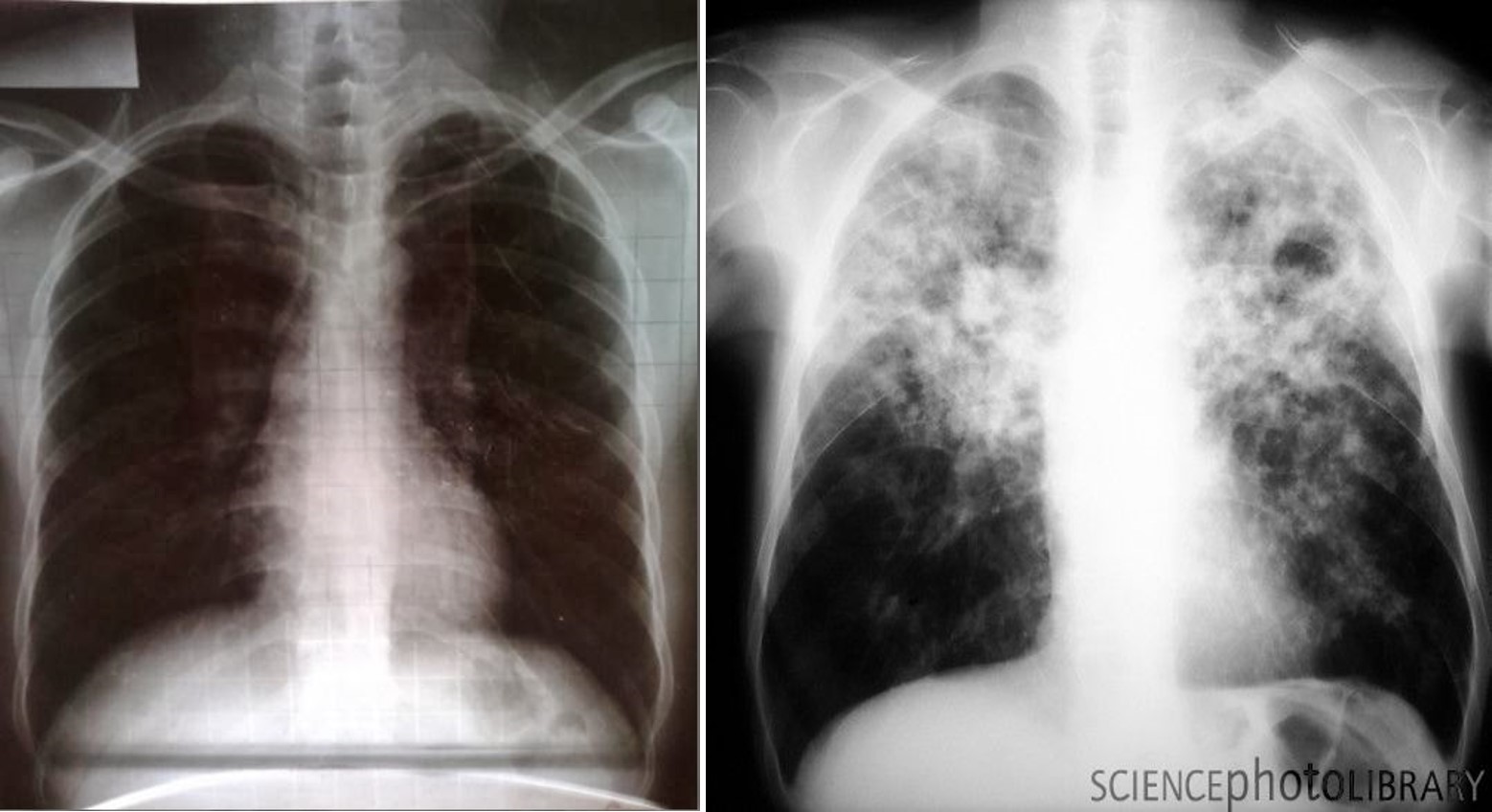 [Materi] Penyakit pada Sistem Pernapasan Manusia ~ ROFA Education Centre
