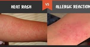 L0ve i5 c!n7a: Heat Rash vs Allergic
