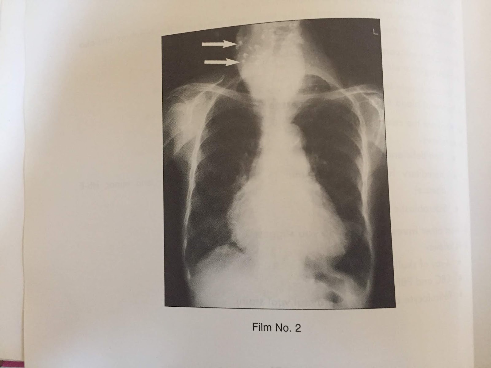 XRAYS OF CALCIFICATION IN NECK
