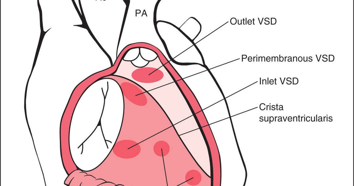 Bác Sĩ Võ Tá Sơn: [Siêu âm tim thai] Thông liên thất - Ventricular ...