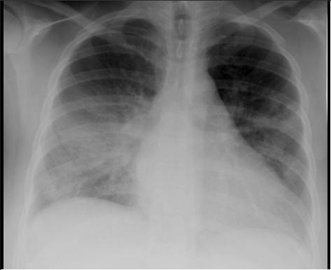 Respiratory Therapy Cave: Tips for reading chest x-rays