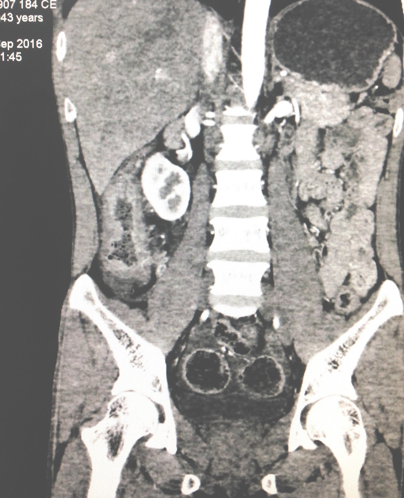 VIETNAMESE MEDIC ULTRASOUND: CASE 394: COLON TUBERCULOSIS, Dr PHAN ...