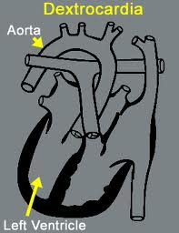 COCHIN CARDIAC CLUB: DEXTROCARDIA