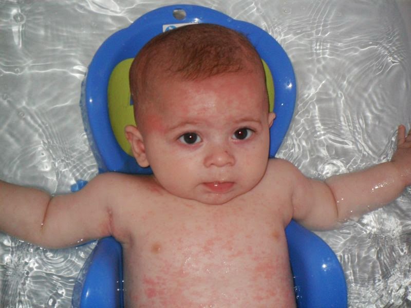 Les Maladies Des Bébés