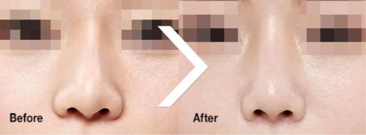 ID Hospital Korea: [ID hospital] What is nose revision?