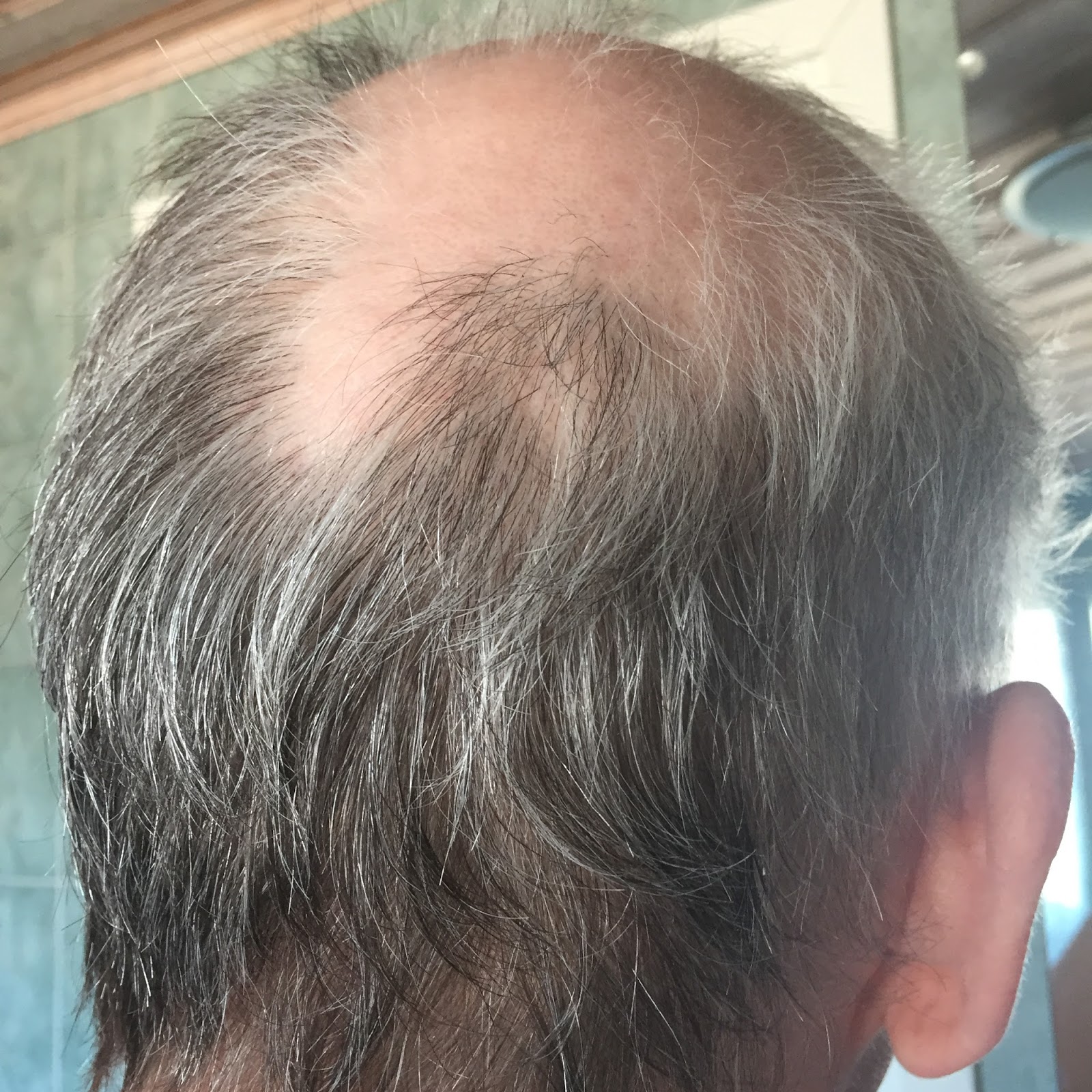 MITT LIV MED ALOPECI - ALOPECIA: RAKA ELLER INTE RAKA...?