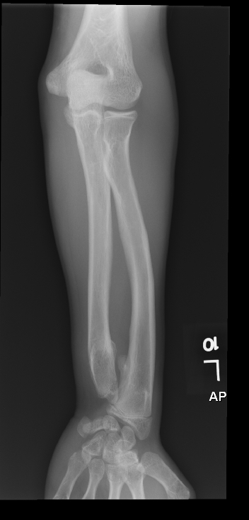 Young Adult with Multiple Hereditary Exostoses | Congenital Hand and ...