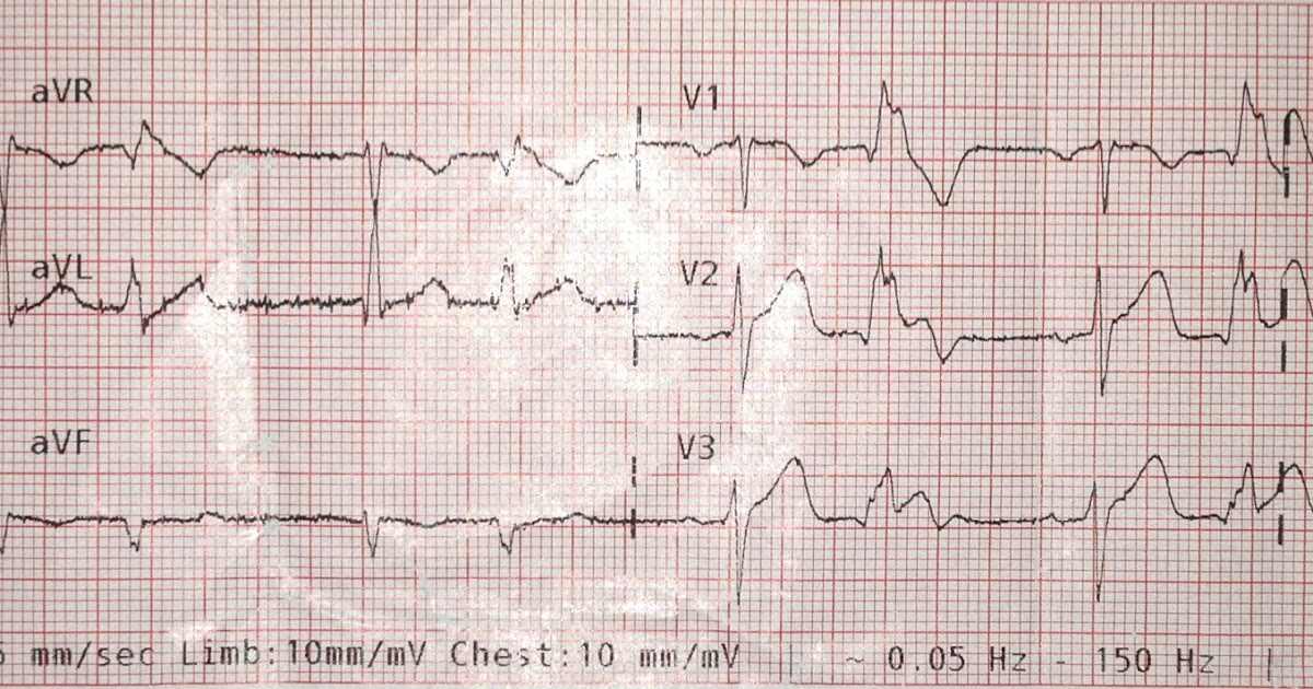 Dr. Smith's ECG Blog: STEMI Seen Best in PVC, Diagnosed by Medic ...