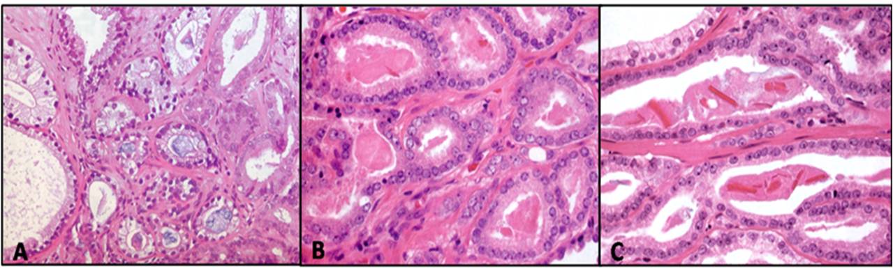 GO BIG or GO HOME: Pathology of prostate gland adenocarcinoma and its ...