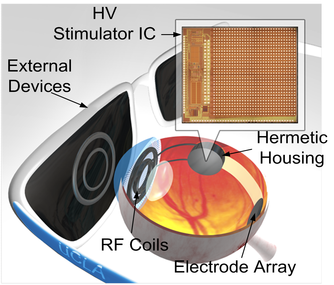 Bionic eyes and arms: Retinal Prosthesis Argus® II