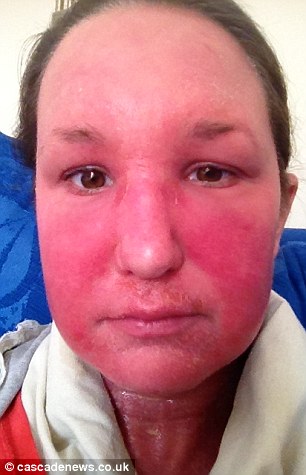 Scarlet Letters, dealing with vascular rosacea, face flushing, burning ...