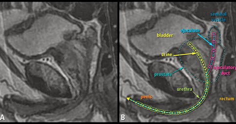 Radiology Anatomy Images : Prostate MRI Anatomy