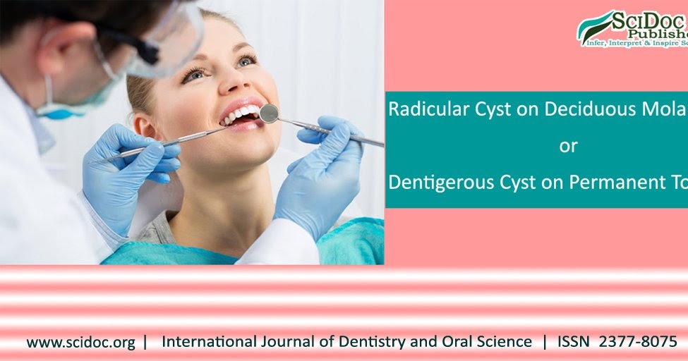 Dental - Research of Radicular Cyst on Permanent Tooth