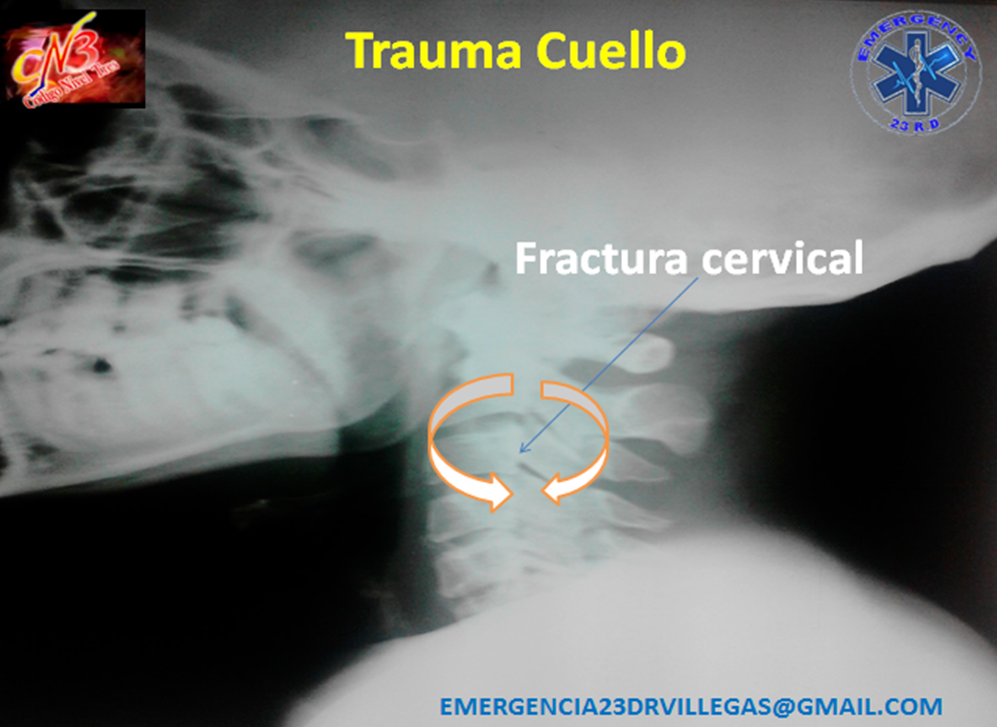 EMERGENCIA23RD,SRL: TRAUMA DE CUELLO
