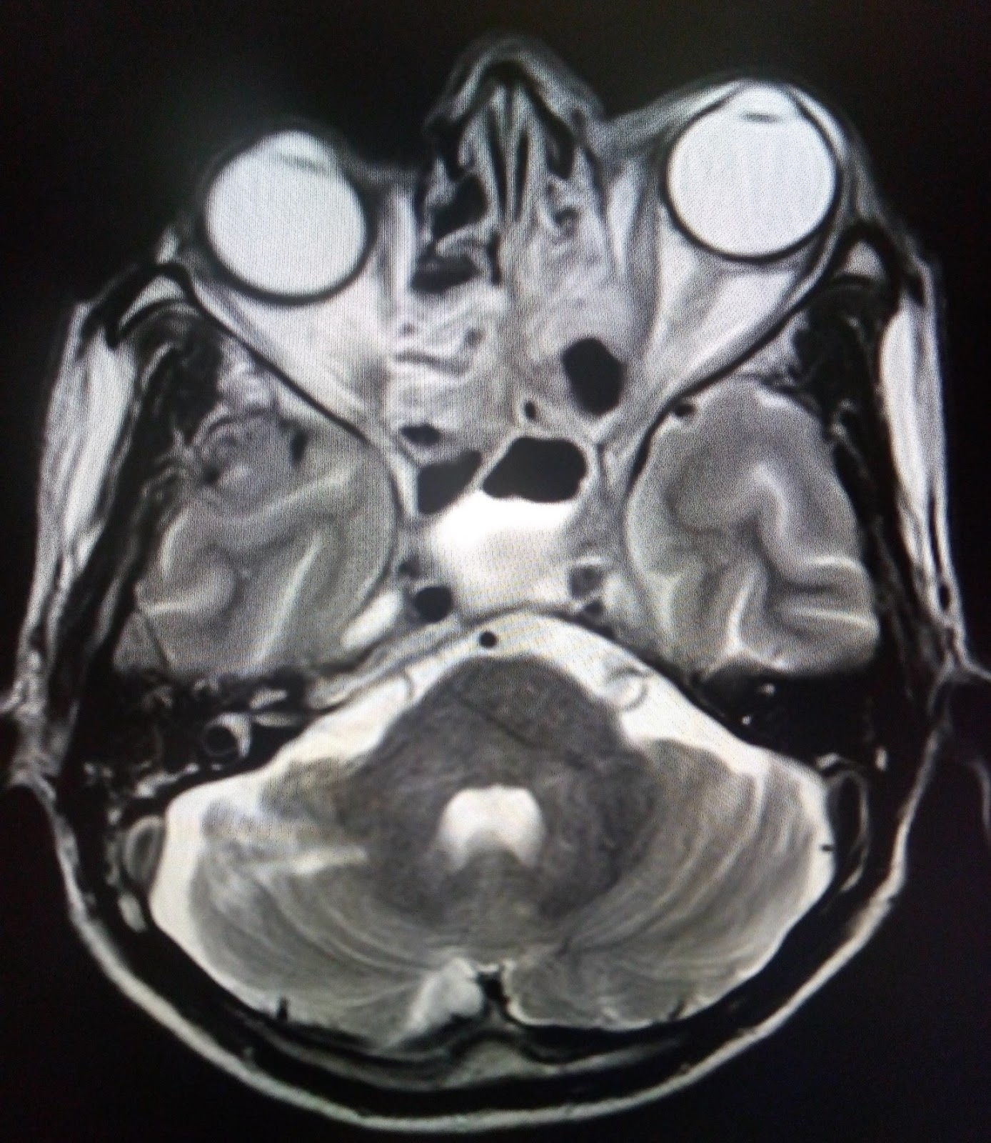 Cavernous Sinus Thrombosis Case Report Sumers Radiology Blog