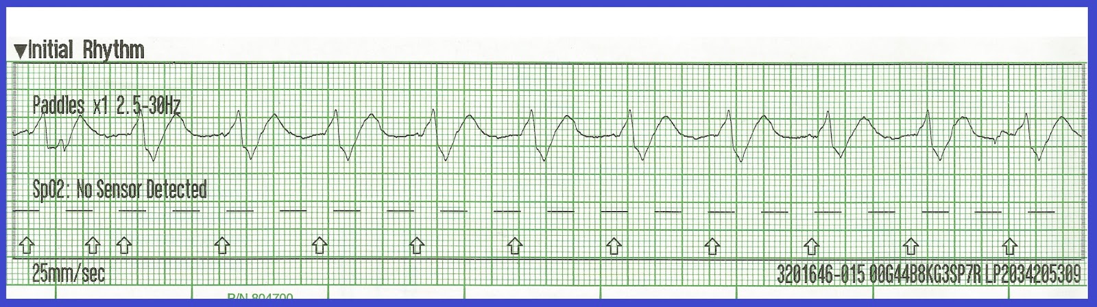 Code Blue: Sudden Cardiac Arrest