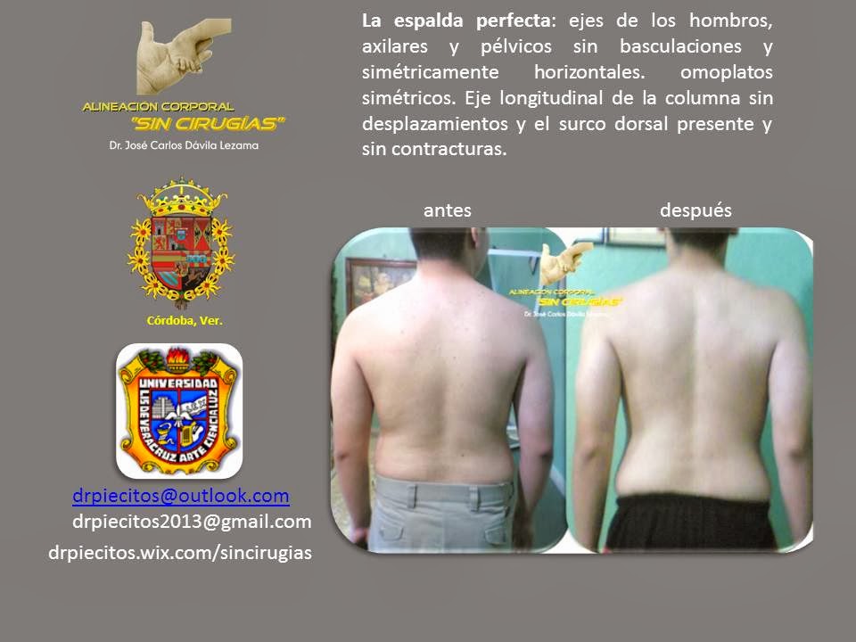 SIN CIRUGÍAS en LÍNEA: LA IMPORTANCIA del SURCO MEDIO POSTERIOR de la ...