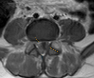 Arachnoiditis-MRI - Sumer's Radiology Blog
