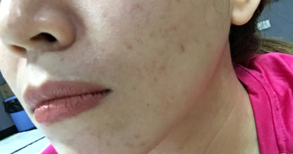 Pink Paradox: REVLITE FROM SKIN 101 REVIEW