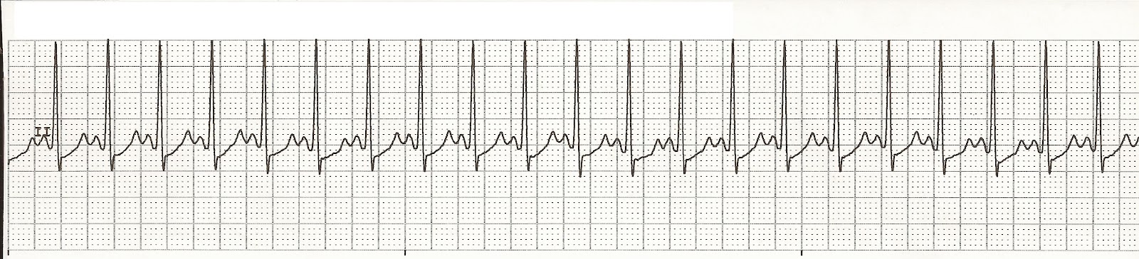 EKG Rhythm Strips 59
