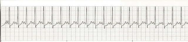 EKG Rhythm Strips 59