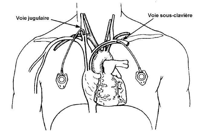 Pose de perfusion et injection sur CIP | Récap' IDE