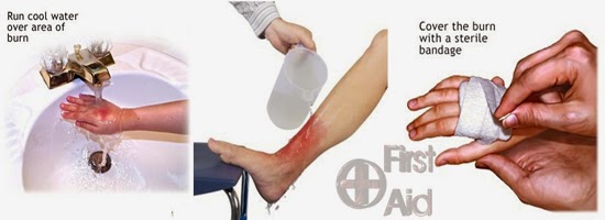 Pertolongan Pertama Penanganan Luka Bakar - Guntur Sapta Blog
