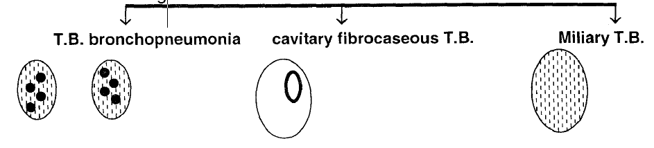 Pulmonary Tuberculosis def., causes, risks, pathology, types ~ Med2Date