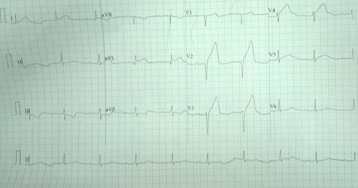 Cardiology window: First degree AV block associated with acute anterior ...