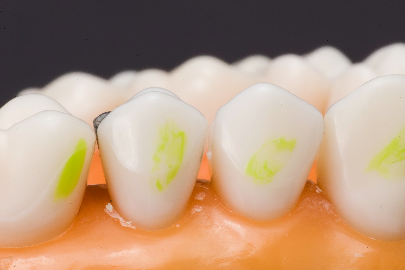 MOD Composite Preparation and Restoration 1: #12 MOD preparation #13 DO ...