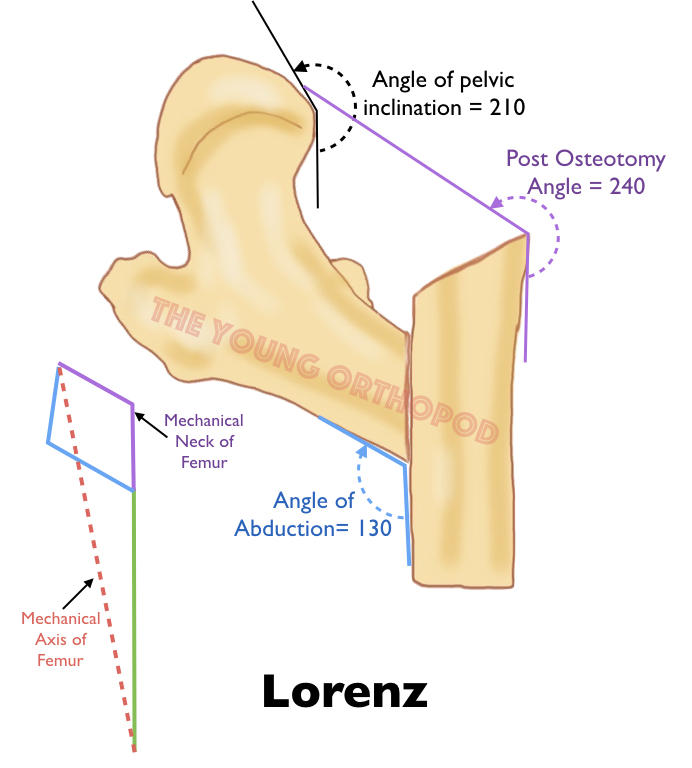 Pelvic Support Osteotomy