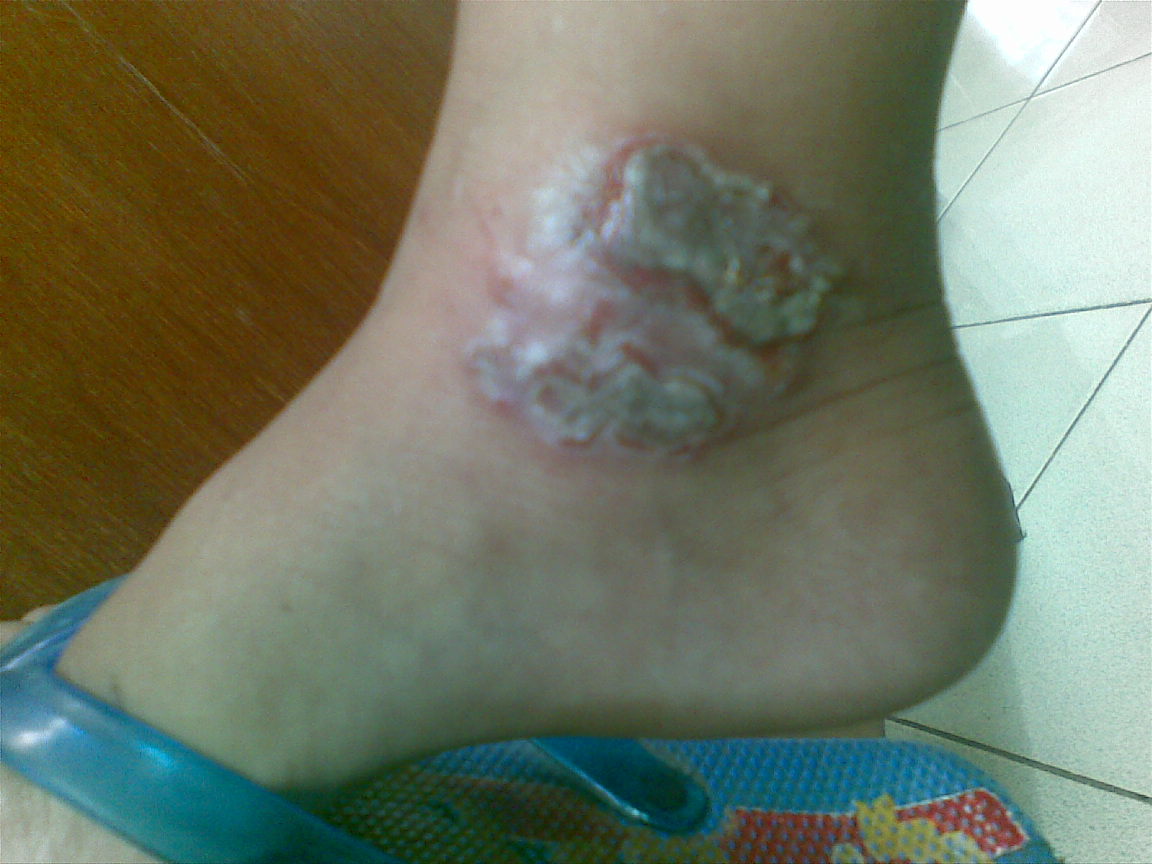 kesehatan: dermatitis numularis