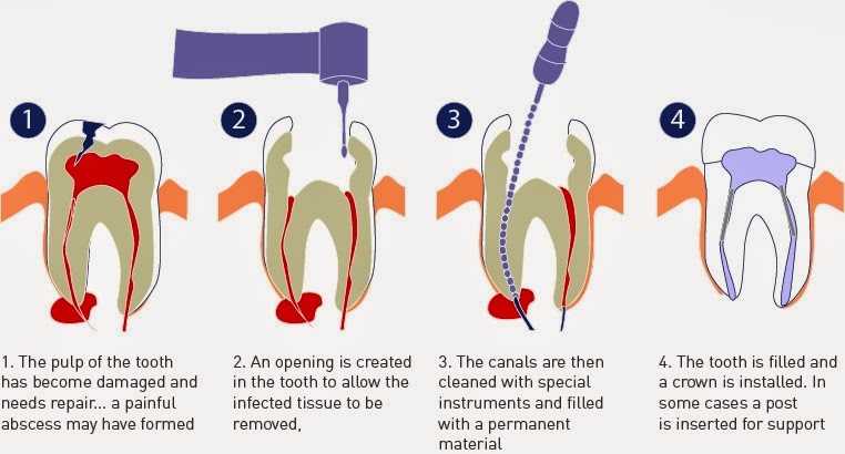 Pengalaman | Root Canal Treatment (Rawatan Matikan Akar)