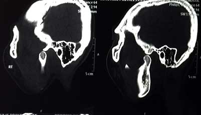 EMINECTOMY TO CORRECT DISLOCATION OF THE CONDYLE - Richardson dental ...