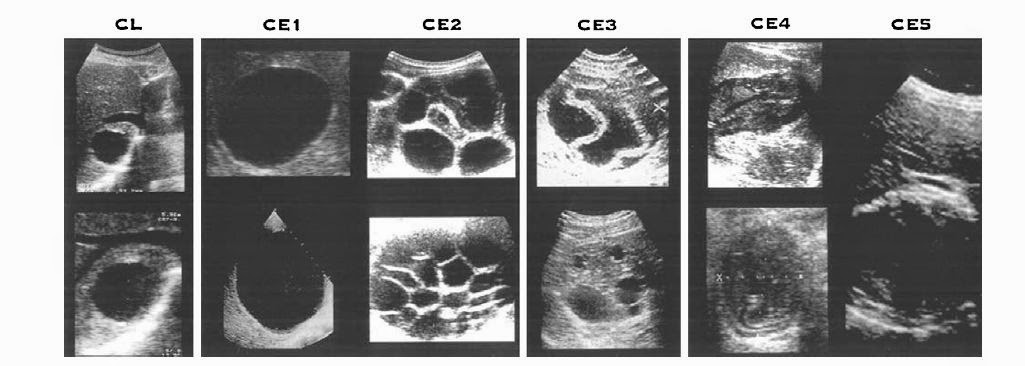 Revision Casos De Cirugia General: QUISTE HEPATICO HIDATIDICO ...