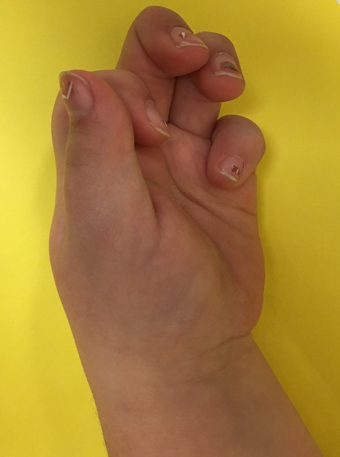 The Hand in Multiple Epiphyseal Dysplasia | Congenital Hand and Arm ...