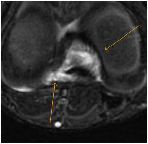Unsual ganglion cyst in intercondylar notch in childern - Sumer's Radiology Blog