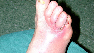 Arterial insufficiency ulcer - Ulcer Choices