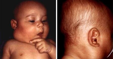 Medical Health Treatment and Therapy : Lymphangioma Signs and Symptoms