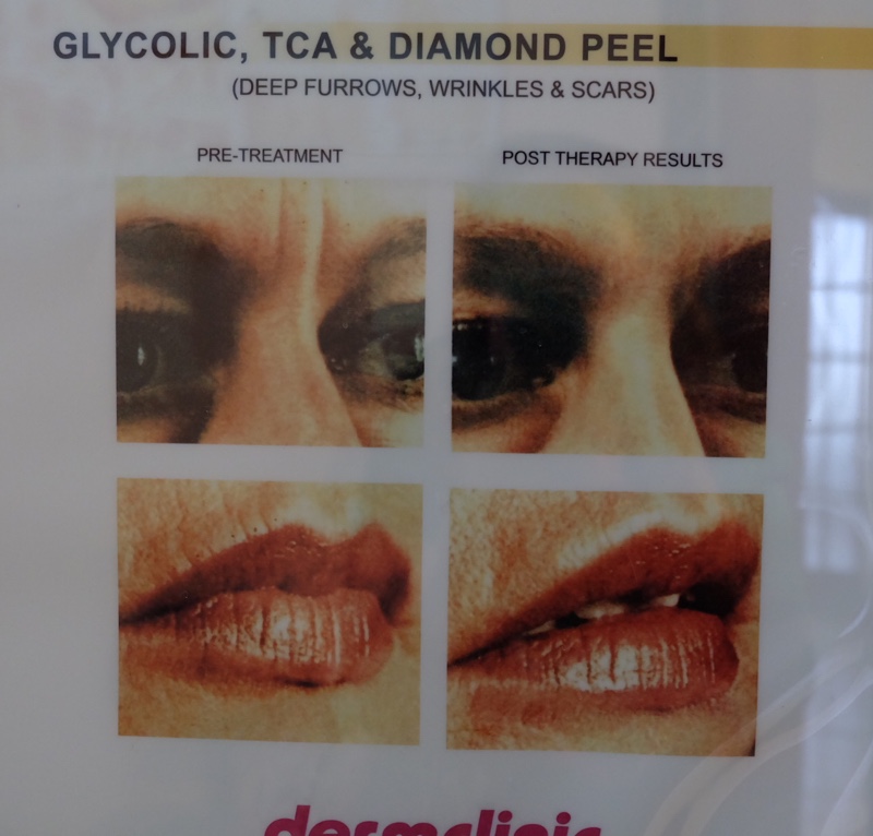 Fight Breakouts with Intense Diamond Peel - Rochelle Rivera