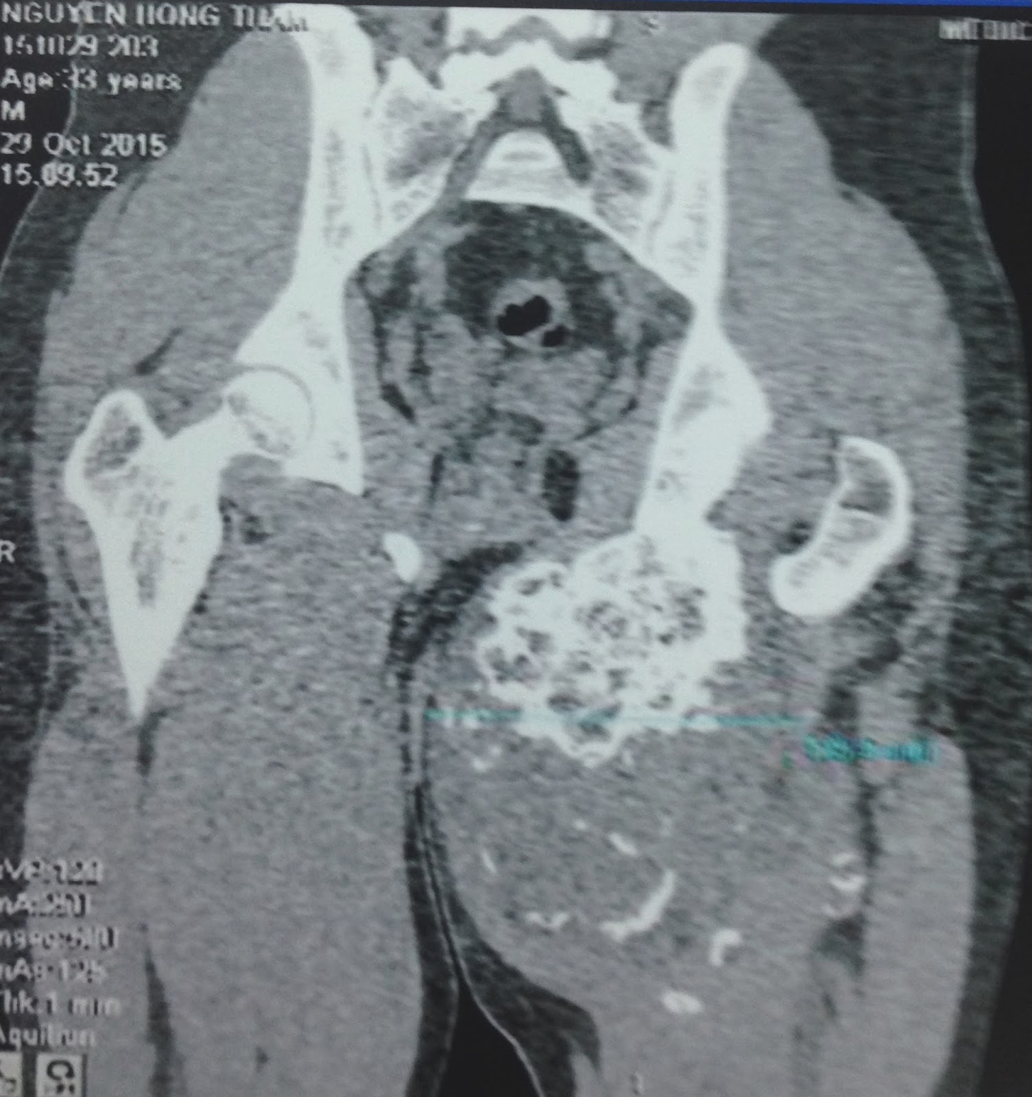 VIETNAMESE MEDIC ULTRASOUND: CASE 344 :LEFT GROIN TUMOR, Dr PHAN THANH ...