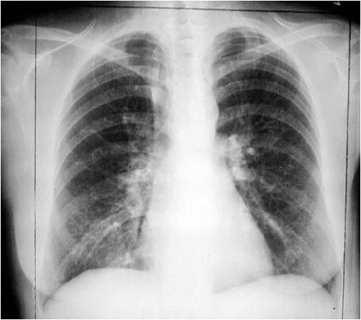 RADIOLOGY IMAGE SPOTTERS: Right middle lobe collapse