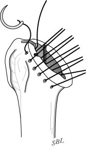 Shoulder Arthritis / Joint Replacement : Shoulder arthroplasty for ...